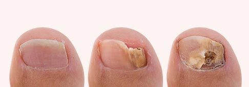 "Nail fungus affects the blood and causes necrosis. A solution exists ...