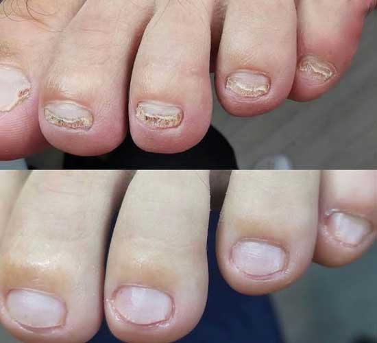 "Nail fungus affects the blood and causes necrosis. A solution exists ...