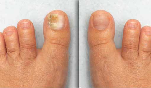 "Nail fungus affects the blood and causes necrosis. A solution exists ...