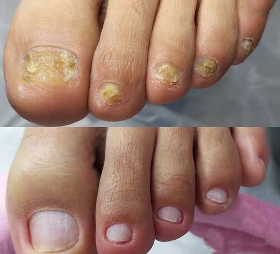 "Nail fungus affects the blood and causes necrosis. A solution exists ...
