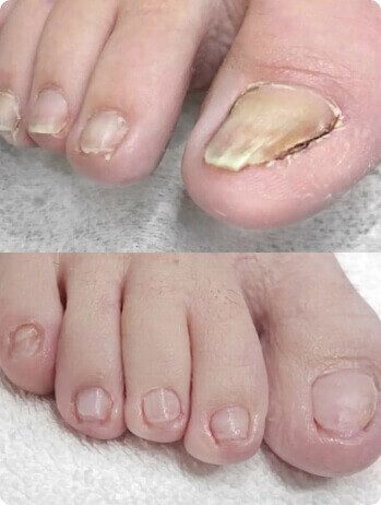 Unexpected Discovery: Nail Fungus Causes Blood Infection and Necrosis