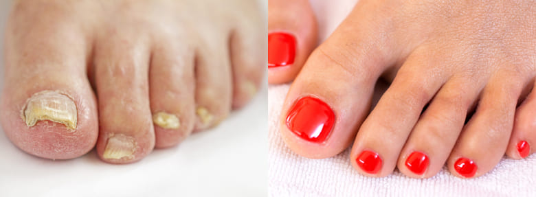 Unexpected Discovery: Nail Fungus Causes Blood Infection and Necrosis