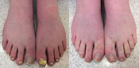 Unexpected Discovery: Nail Fungus Causes Blood Infection and Necrosis