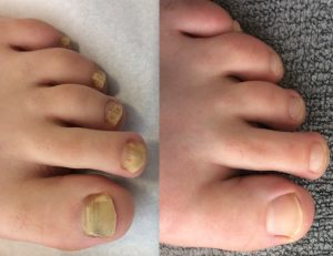 Unexpected Discovery: Nail Fungus Causes Blood Infection and Necrosis