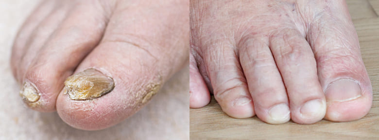 Unexpected Discovery: Nail Fungus Causes Blood Infection and Necrosis