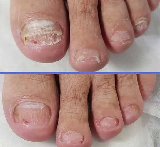 Unexpected Discovery: Nail Fungus Causes Blood Infection and Necrosis