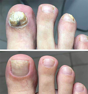Unexpected Discovery: Nail Fungus Causes Blood Infection and Necrosis