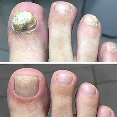 Unexpected Discovery: Nail Fungus Causes Blood Infection and Necrosis
