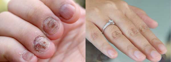 Unexpected Discovery: Nail Fungus Causes Blood Infection and Necrosis